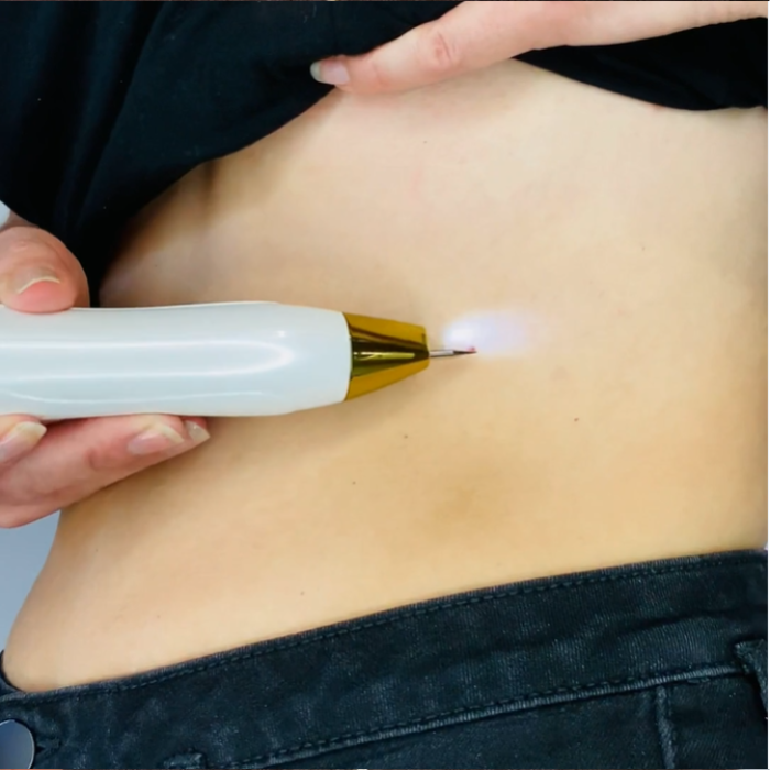 Ocura Plasma Pen Ultimate Bundle Ocuralife